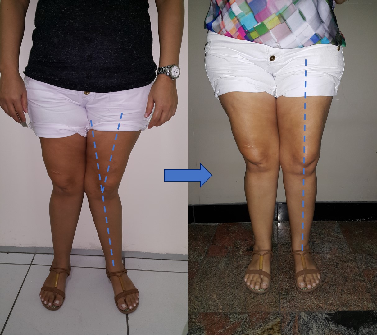 Osteotomia de Realinhamento do Fêmur - Dr. Felipe Brasil